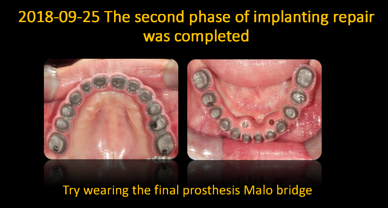 Application case of 3d digital printing implanting technology in the ...