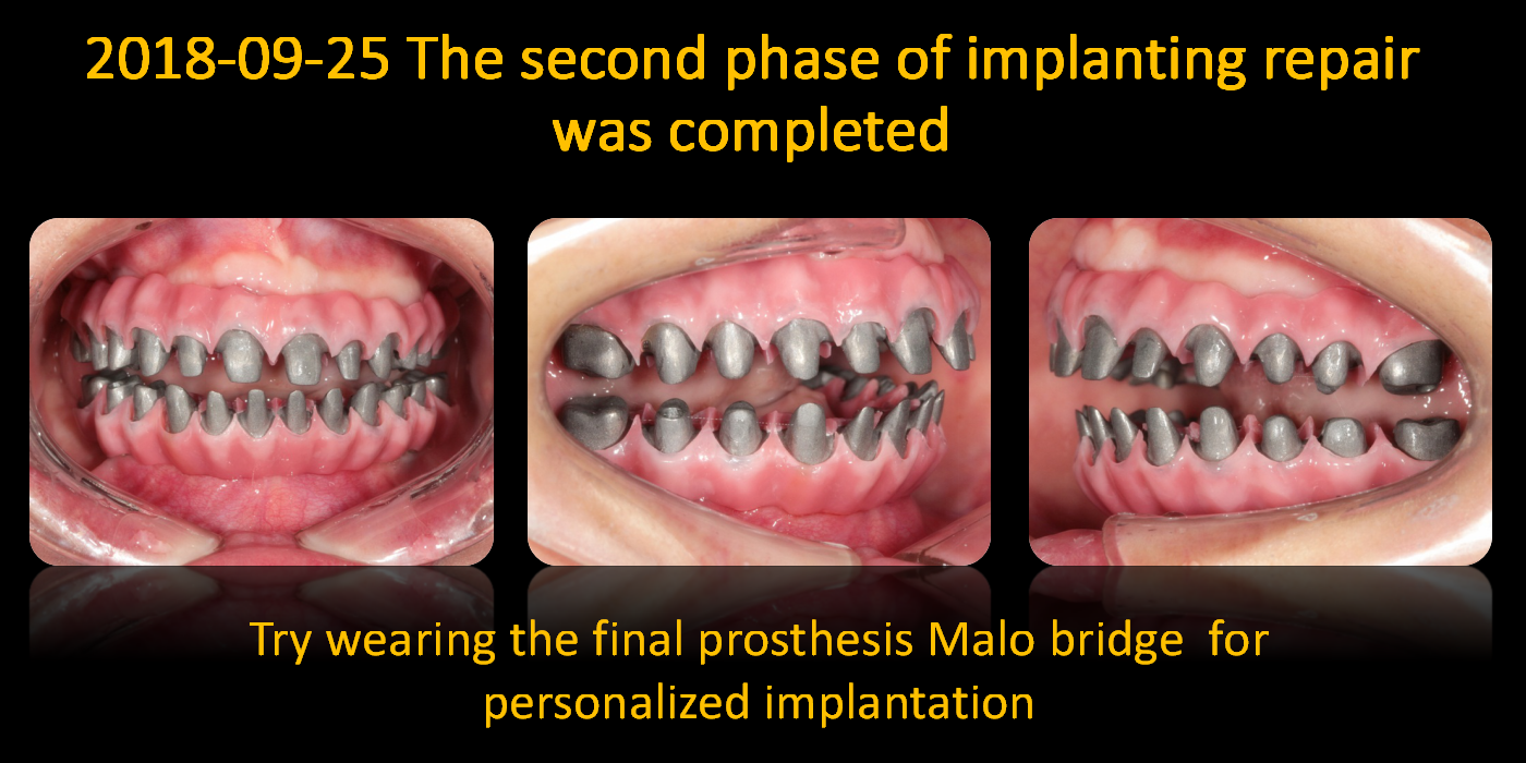 Application case of 3d digital printing implanting technology in the ...